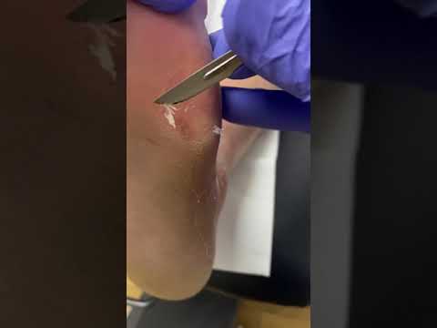 Watch a Podiatrist Remove Corns and Calluses from the Ball of the Foot | Effective Corn Removal