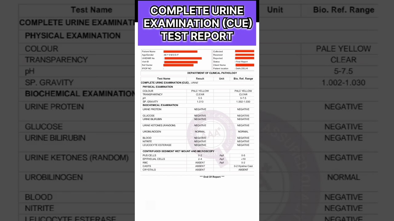 COMPLETE URINE EXAMINATION (CUE) TEST REPORT #shorts #viral #urine