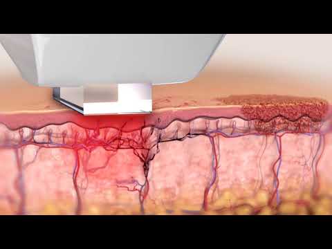 How Does Lumecca IPL Photo Rejuvenation Work?