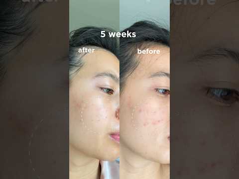 reedle shot 100 (before and after) #microneedling #koreanskincare #skincarereview