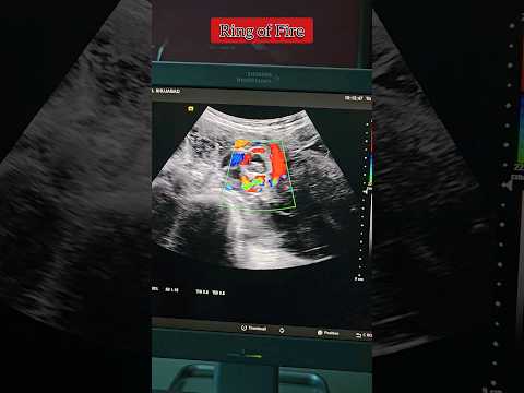Ectopic pregnancy with alive fetus #medical #doppler #ultrasound #radiology #ectopicpregnancy #viral