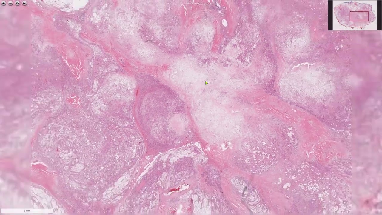 Pleomorphic adenoma- straight-forward example