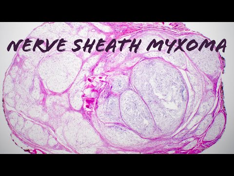 Nerve sheath myxoma with Verocay palisading (formerly myxoid neurothekeoma) (pathology dermpath)