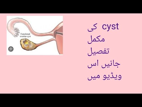 detailed video on simple cyst in Urdu / what is hemorrhagic cyst/cyst in overy and it's treatment