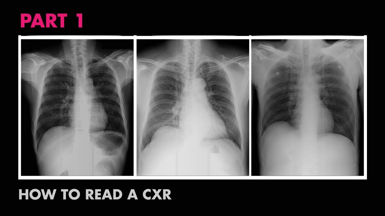 Anatomy of a Chest X-Ray - How to Read a Chest X-Ray (Part 1)