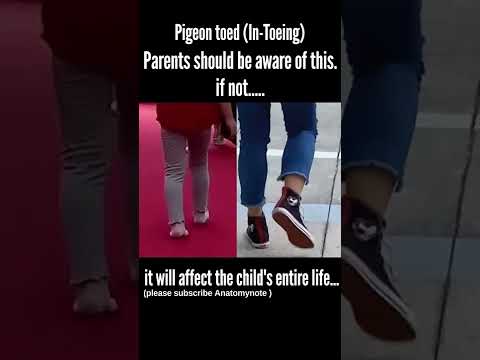 Pigeon Toed walking (In-toeing) baby walking | parents should be aware of #shorts