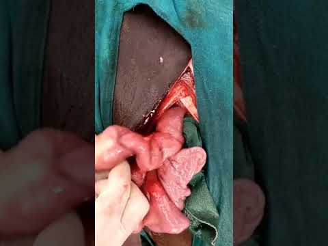 Manual reduction of intussusception by retrograde milking in a cow