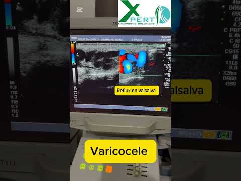 Varicocele Doppler!#ultrasound #radiology #pakistan #medical #awareness #education #world #male #obs