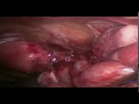 Terminal Ileum Endometriosis Misdiagnosed as Chron's Disease, 24s