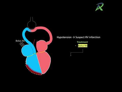 ACS MR Teaser #usmle #internalmedicine #coronary