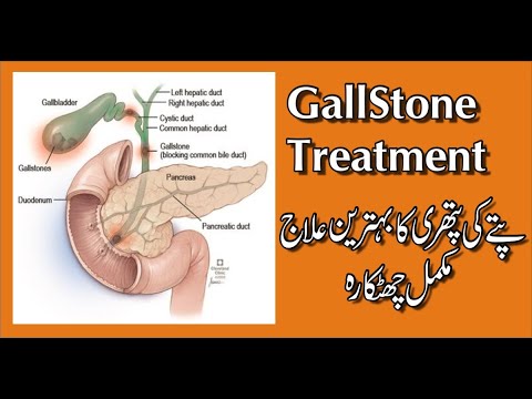 Gallbladder Stone best Treatment | Cholelithiasis | urdu/hindi