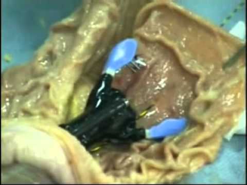 Complete Endoscopic Closure of Gastrotomy Following Natural Orifice Translumenal Endoscopic Surgery
