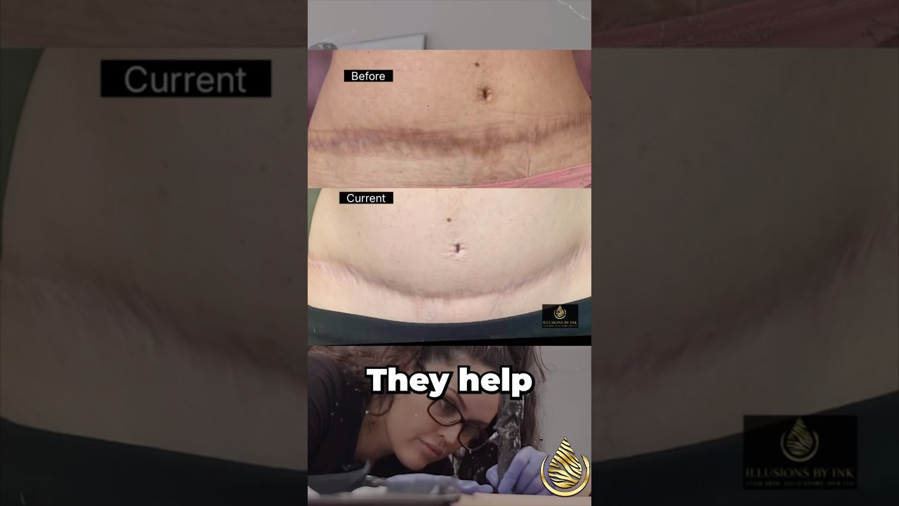 👍 How to Improve Tummy Tuck Scars | Camouflage Tattoo