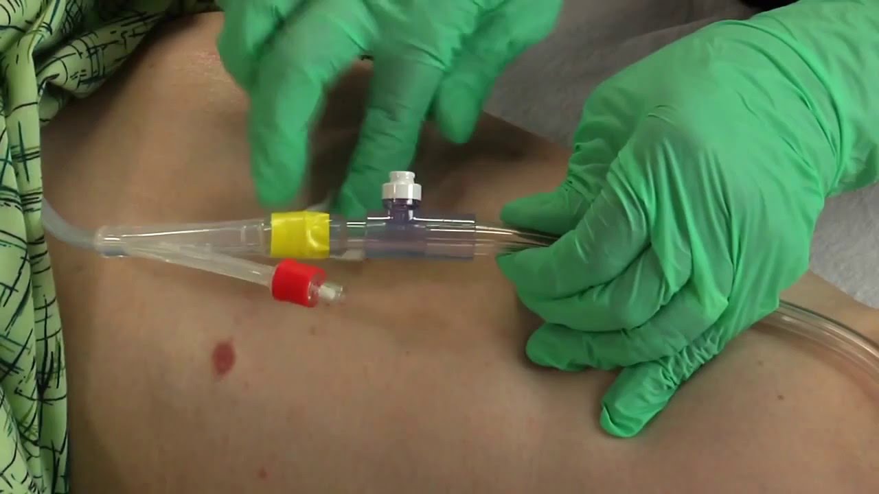 Adhesive Foley Securement Device