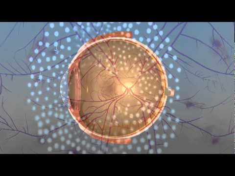 Vitrectomy Surgery for Diabetic Retinopathy