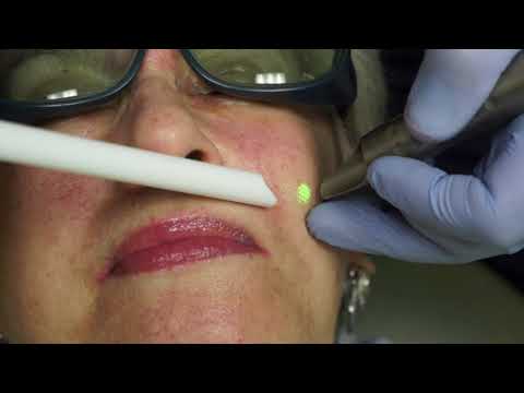 Dr Acula Facial Rejuvenation with the Fotona Lightwalker Laser and I-PRF