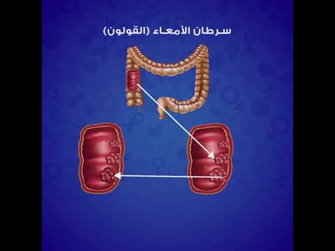 Definition of Bowel Cancer