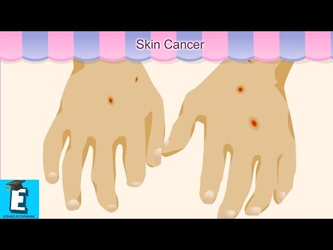 Skin Cancer Learn for Children and Kids | EDUKID Learning