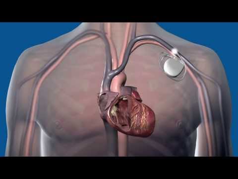 What is a defibrillator, and how does it work?