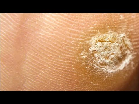 how to get rid of calluses on feet with vinegar fast