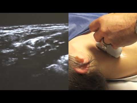 Ultrasound Guided Supraclavicular Nerve Block - SSRAUSA.com
