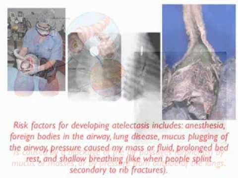 Atelectasis