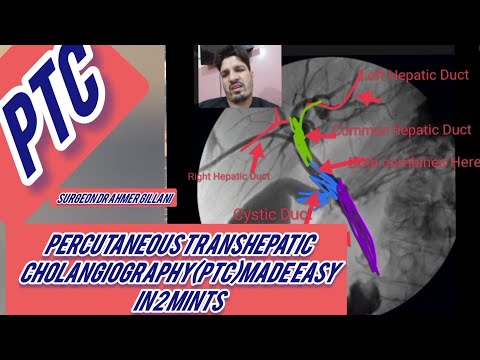 PTC(percutaneous Transhepatic Cholangiography) Made Easy