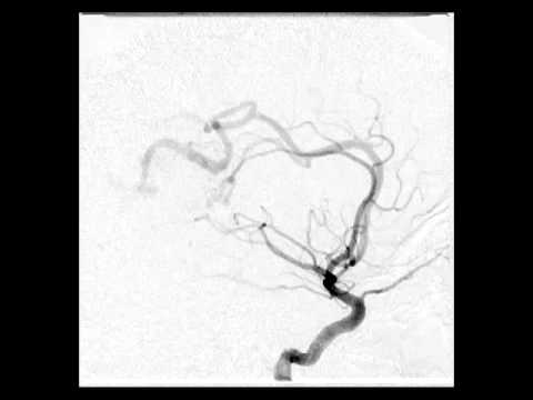 hem15 Bleeding AVMs Bleeding AVM1 Angiogram