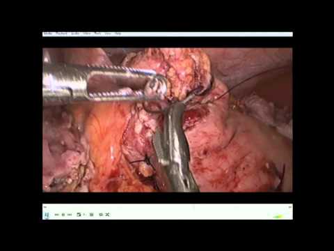 Revision Of Roux-En-Y Gastric Bypass to Sleeve Gastrectomy for Reactive Hypoglycemia