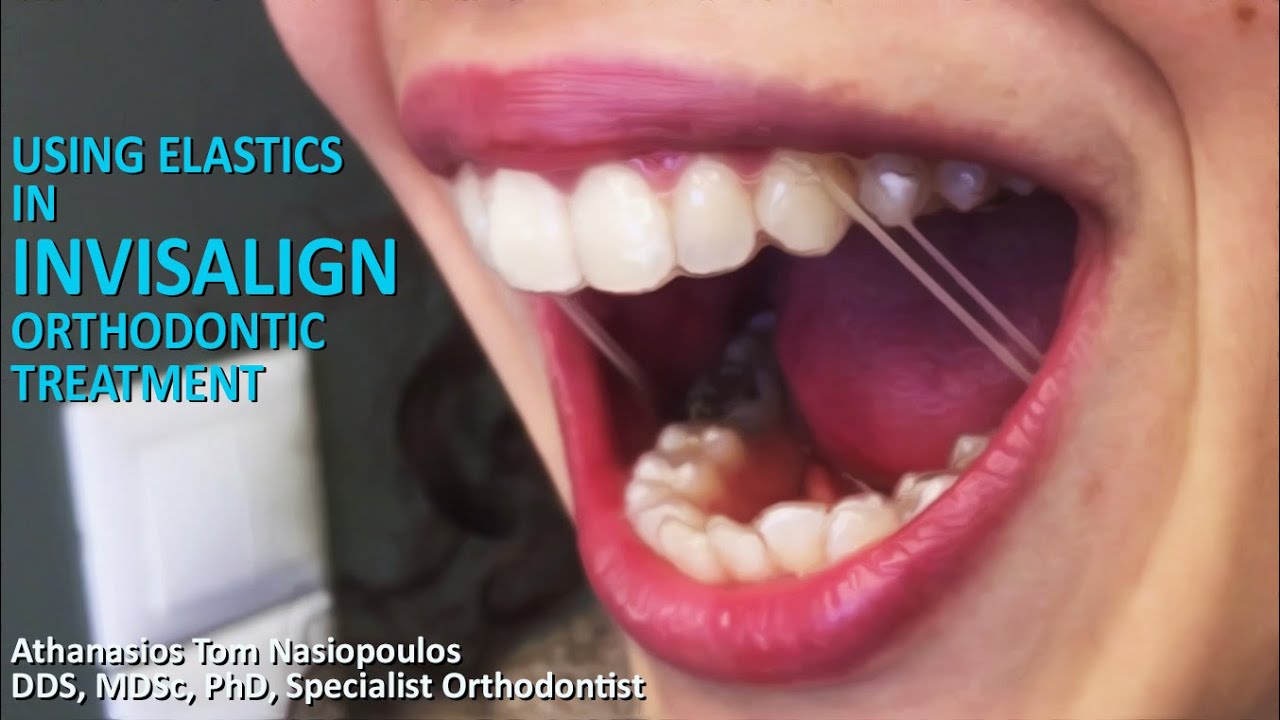 Using Elastics in INVISALIGN Treatment | Athanasios Tom Nasiopoulos