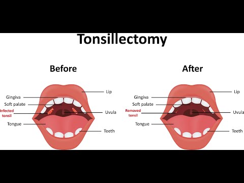 Tonsillectomy CPT code - simplify medical coding