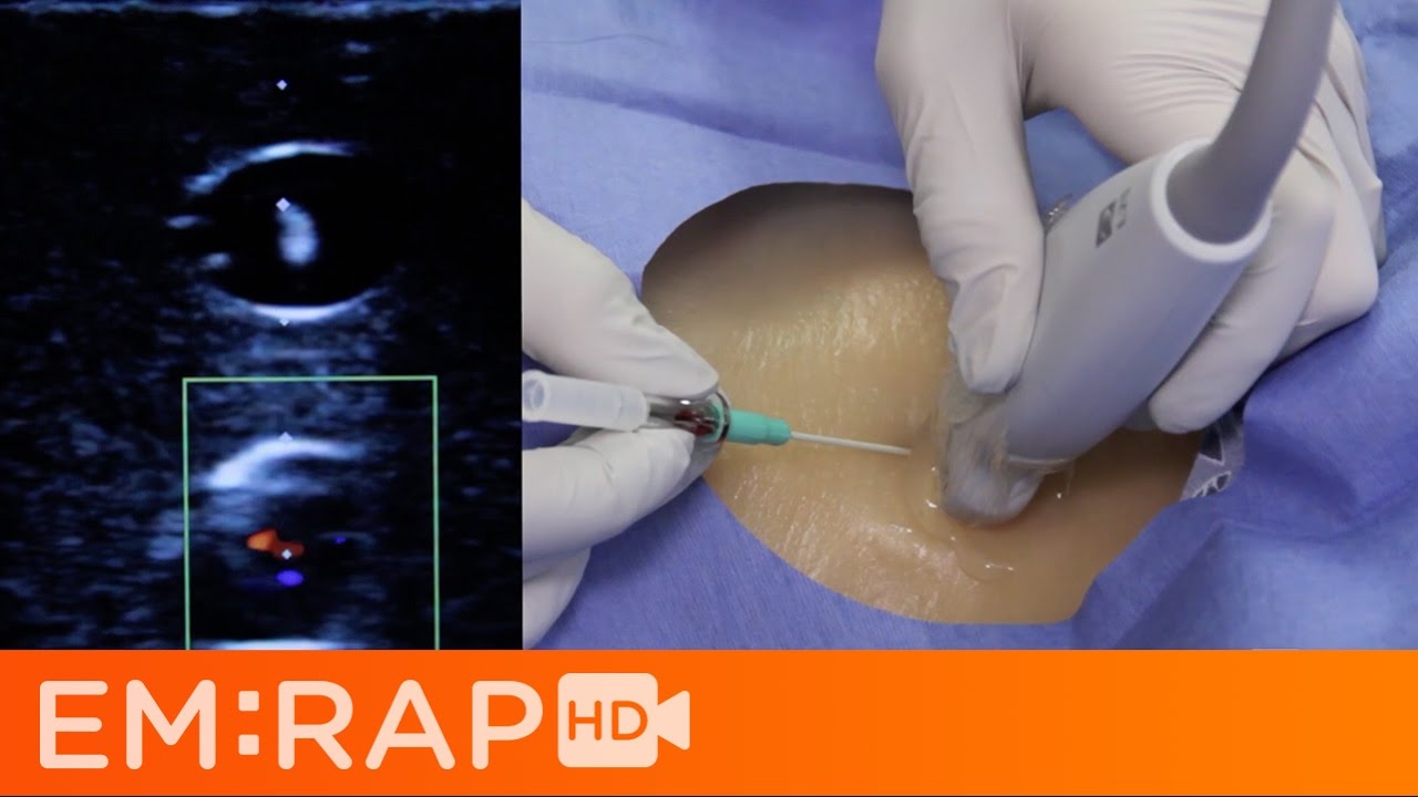 Rapid IJ (aka Easy Internal Jugular Cannulation)
