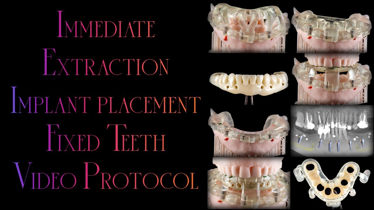 How to use Stackable Surgical Guides?