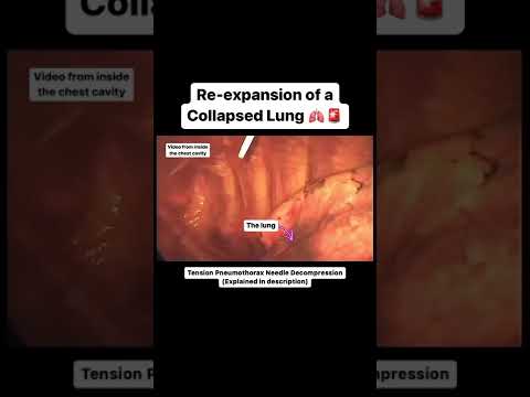 Collapsed Lung Re-expanding via Needle Decompression