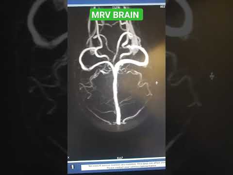 mrv  brain . #mri #ct #shorts #viralvideo