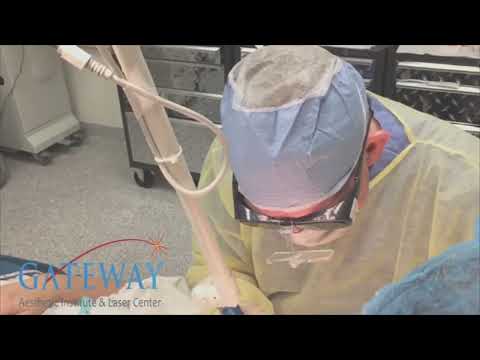 Laser eyelid surgery for eyebags, a simple in-office procedure performed under local anesthetic.