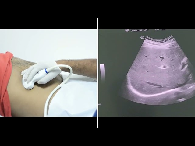 Mastering Liver Ultrasound: A Comprehensive Guide to Transverse ...