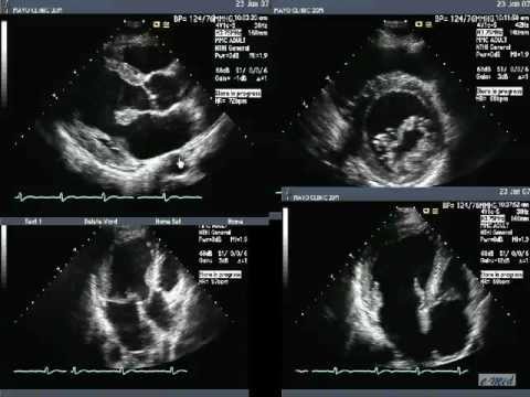 Physiology of Mitral Valve Prolapse: New Insights - Impact on Outcome