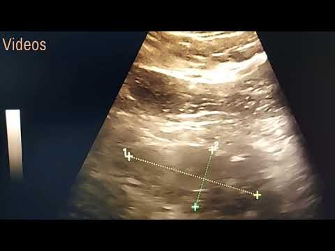 Ectopic Kidney on ultrasound