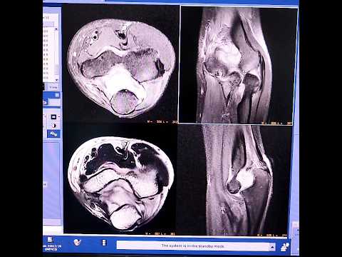 Dislocation of the humerus MRIelbow #mritech #radiology #MRIplaning #radiant #ctscan #x-ray