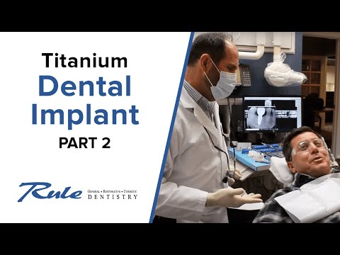Placing a Crown on a Prepared Titanium Dental Implant — PART 2