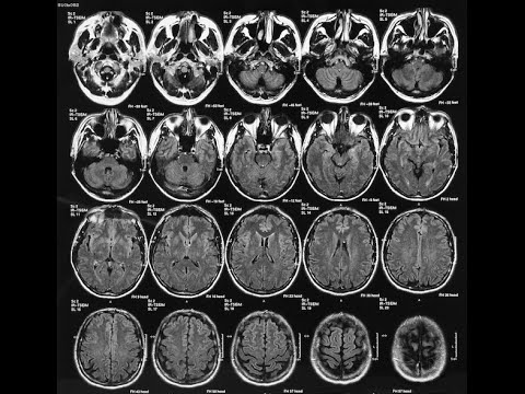 Trial #3- Functional MRI Parameters in SCD