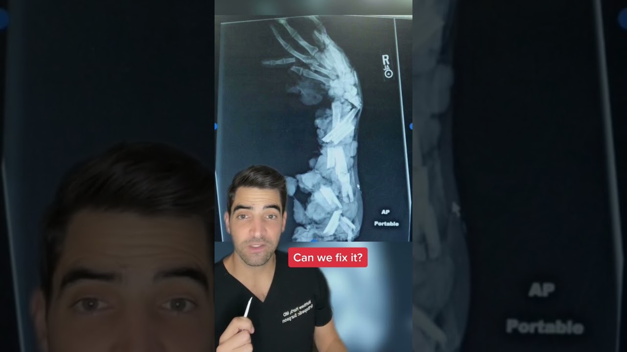 Surgeon talks about extremity trauma and depending on the soft tissue or bones if it can be saved