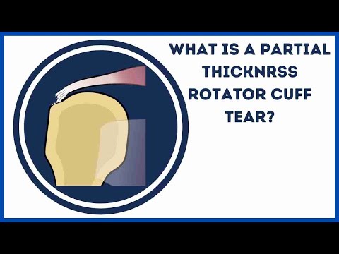What is a partial thickness rotator cuff tear?