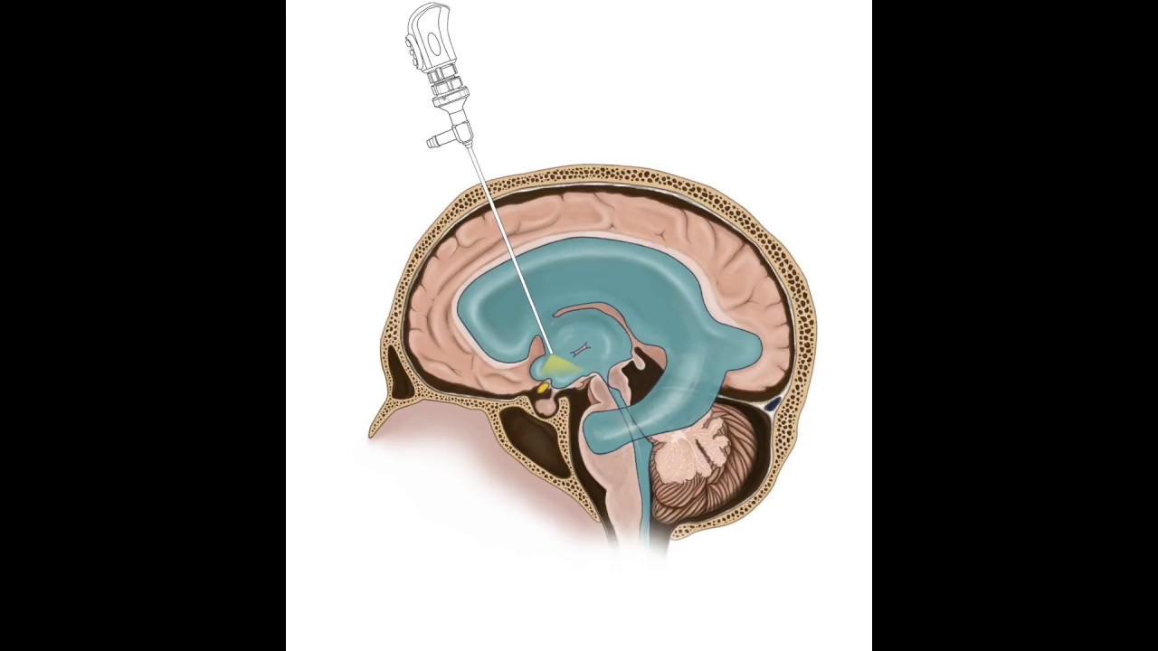 Updated Video Available: Endoscopic Third Ventriculostomy Animation