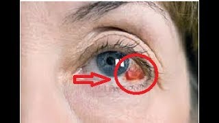 matafuzziblog: Fungsi Bintik Kuning Pada Mata