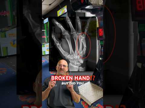 Boxer’s Fracture Complications⁉️ #shorts