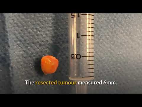 Resection of endobronchial lipoma explained