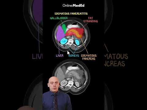 ED Case Study: Diagnosing Acute Pancreatitis & Its Cause