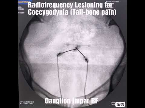 Radiofrequency Ablation for Coccygodynia (Tail-bone pain)